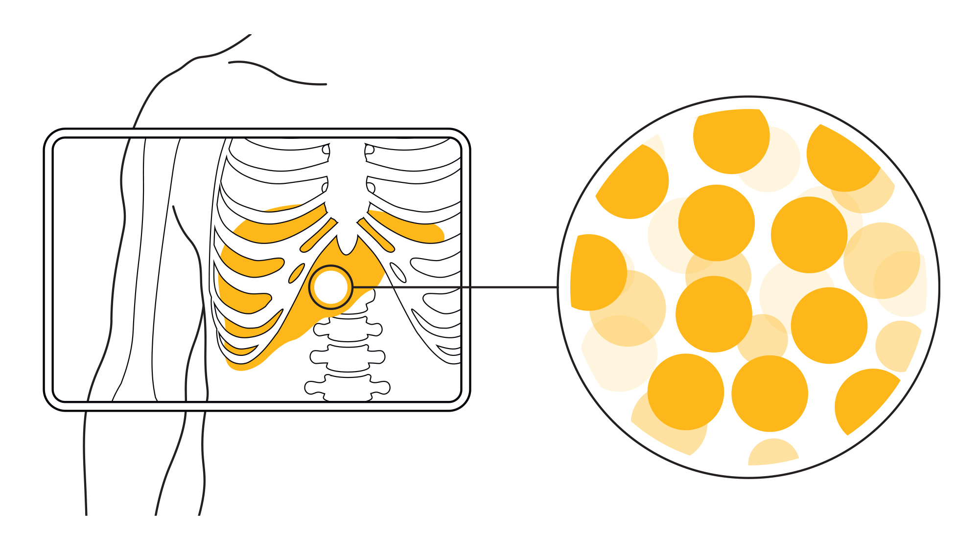 Innovative yttrium-90 transforms liver cancer treatment - NextGen MURR